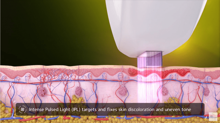 Venus Versa™ - A versatile multi-application platform | Venus Concept