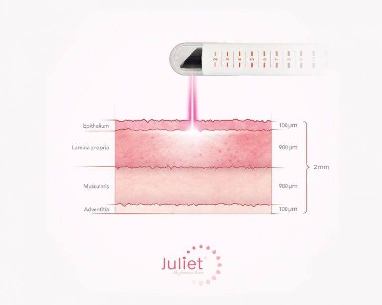 Juliet – the feminine laser | เครื่องรักษาสุขภาพภายในสตรี