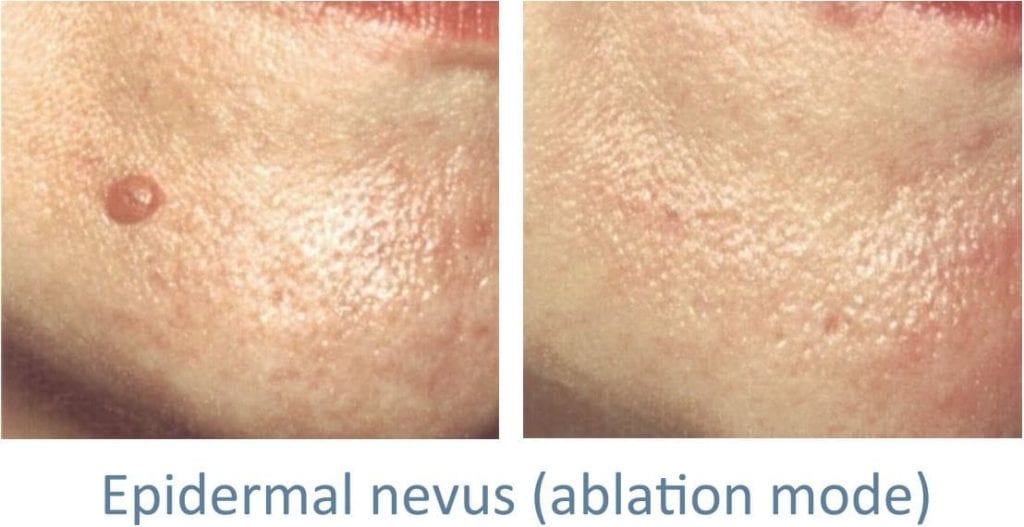 MCL31 Dermablate, Er:YAG Laser | Fractionalskin Rejuvenation