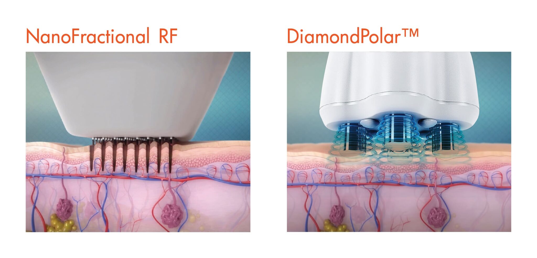 Venus Viva MD | The Next Generation of NanoFractional RF Technology
