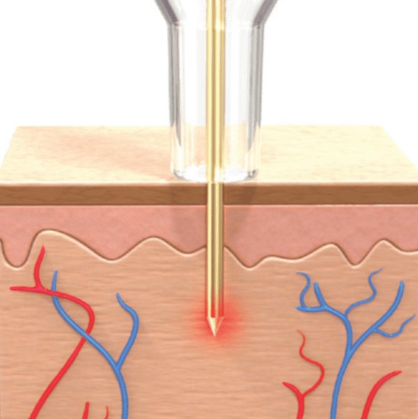 Potenza - เทคโนโลยี 4-MODE RF MICRONEEDLING เครื่องแรกของโลก