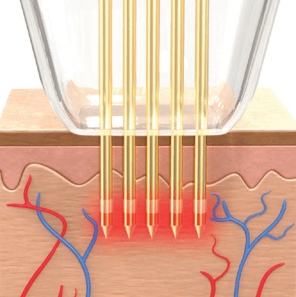 Potenza - The world’s first 4-mode RF Microneedling device