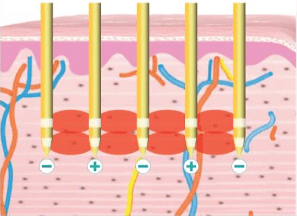 Potenza - The world’s first 4-mode RF Microneedling device