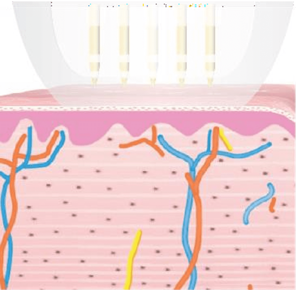 Potenza - The world’s first 4-mode RF Microneedling device