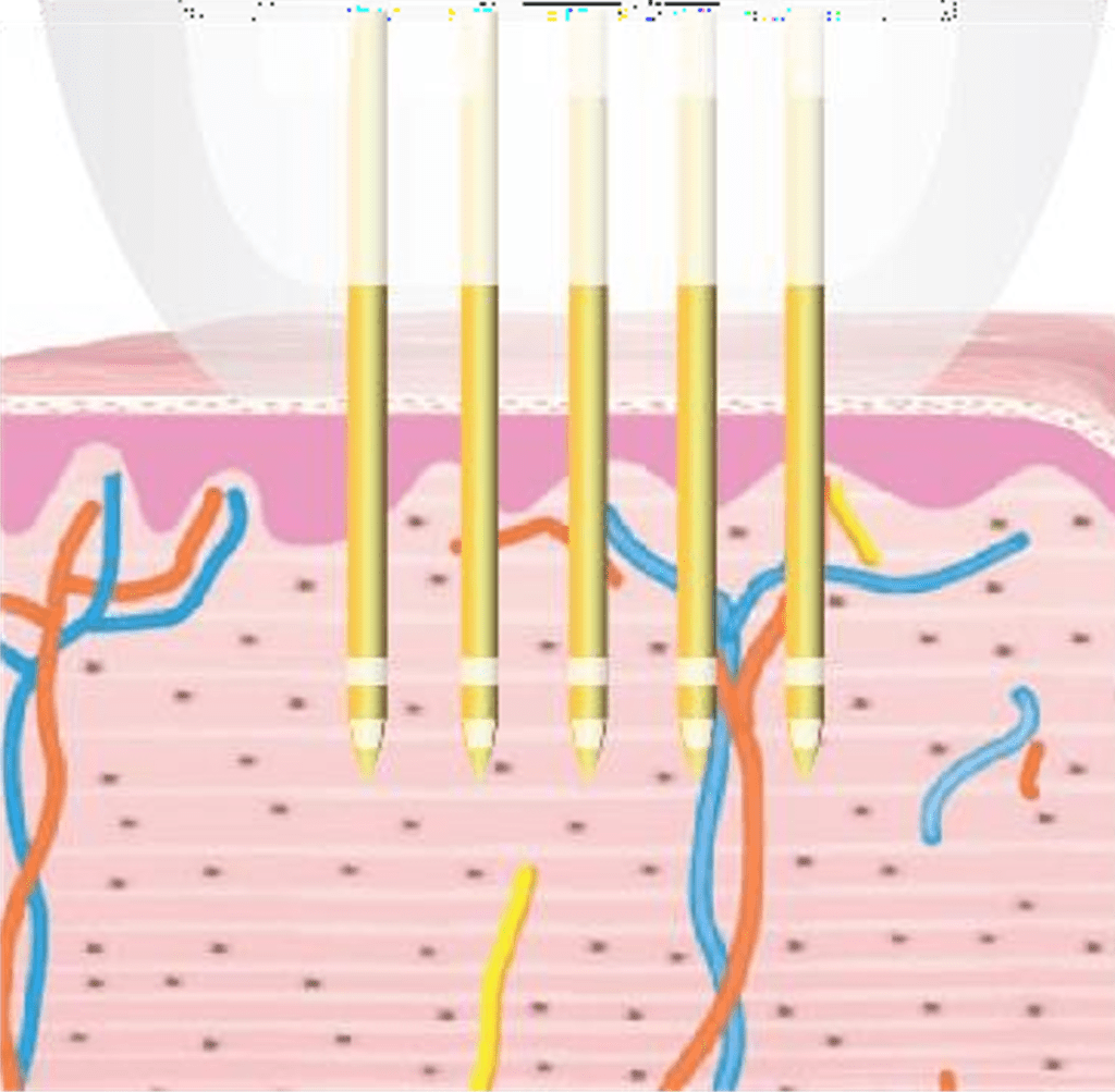 Potenza - The world’s first 4-mode RF Microneedling device