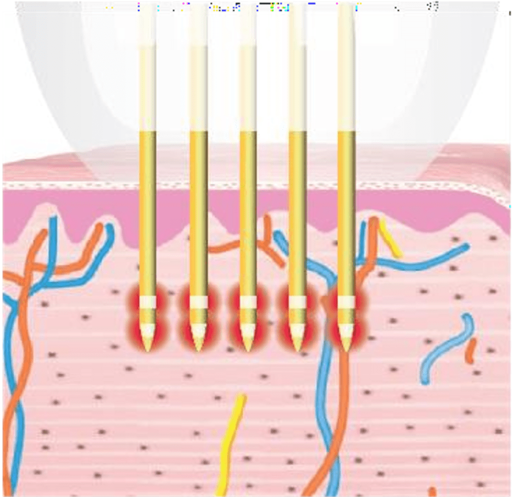Potenza - The world’s first 4-mode RF Microneedling device