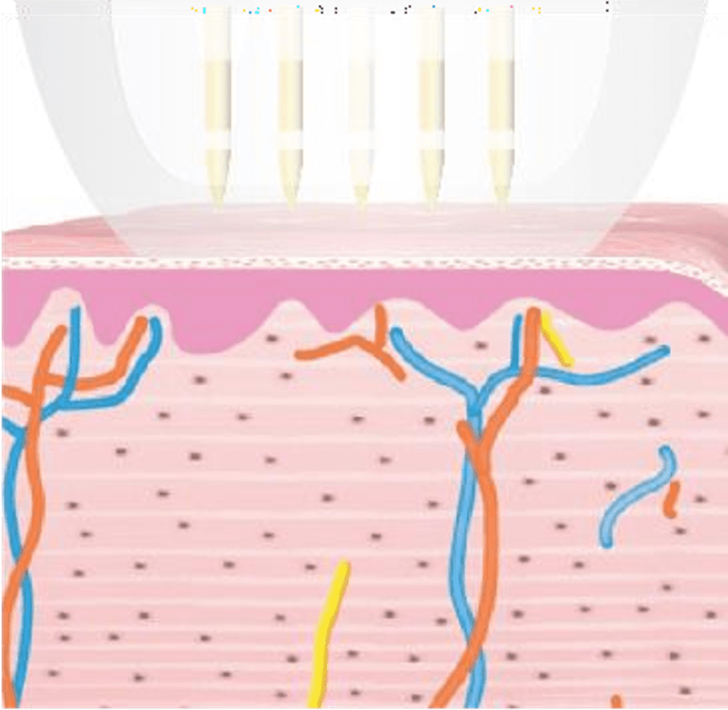 Potenza - The world’s first 4-mode RF Microneedling device