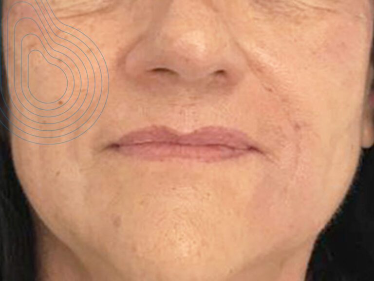 CFU-ÈLIFE, Hyperhidrosis therapy, non-surgical face lift andreduction ...