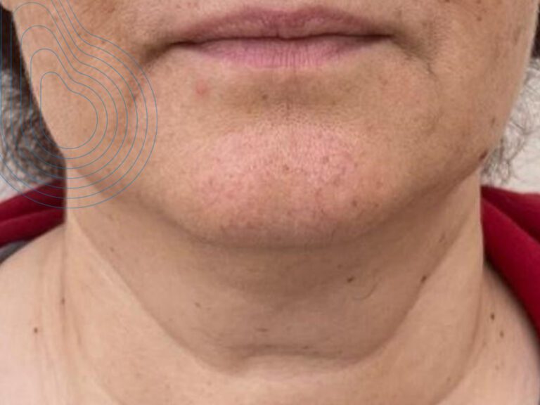 CFU-ÈLIFE, Hyperhidrosis therapy, non-surgical face lift andreduction ...