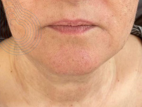 CFU-ÈLIFE, Hyperhidrosis therapy, non-surgical face lift andreduction ...