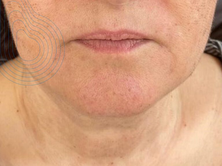 CFU-ÈLIFE, Hyperhidrosis therapy, non-surgical face lift andreduction ...