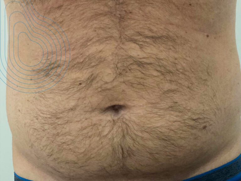 CFU-ÈLIFE, Hyperhidrosis therapy, non-surgical face lift andreduction ...