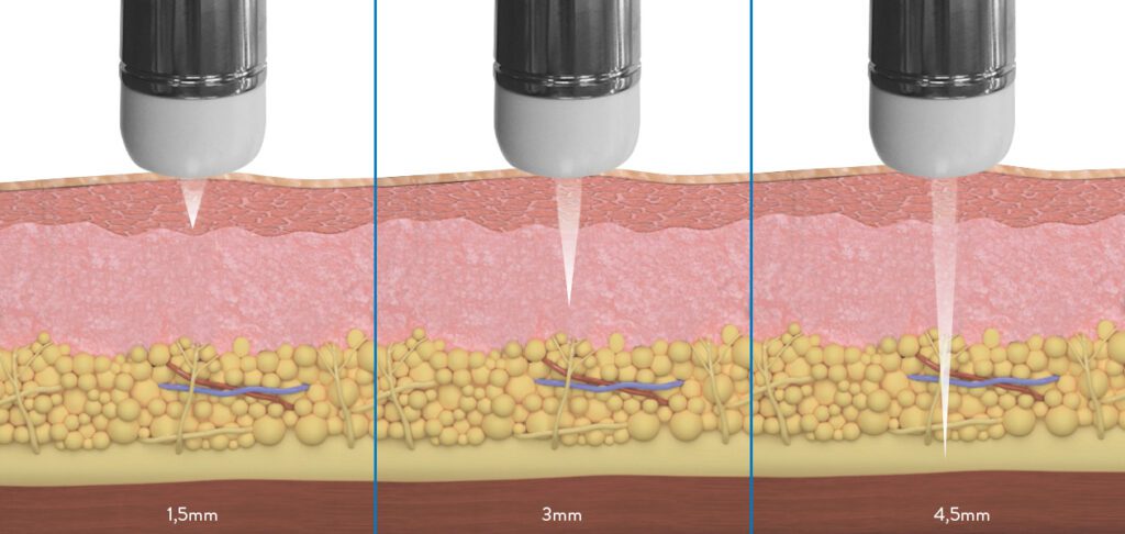CFU-ÈLIFE, Hyperhidrosis therapy, non-surgical face lift andreduction ...