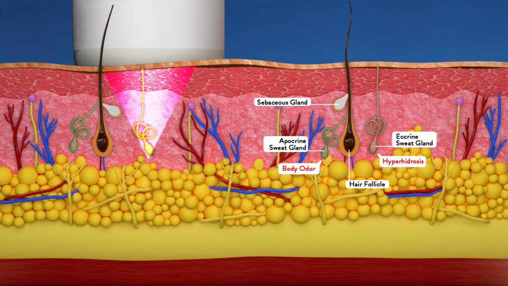CFU-ÈLIFE, Hyperhidrosis therapy, non-surgical face lift andreduction ...