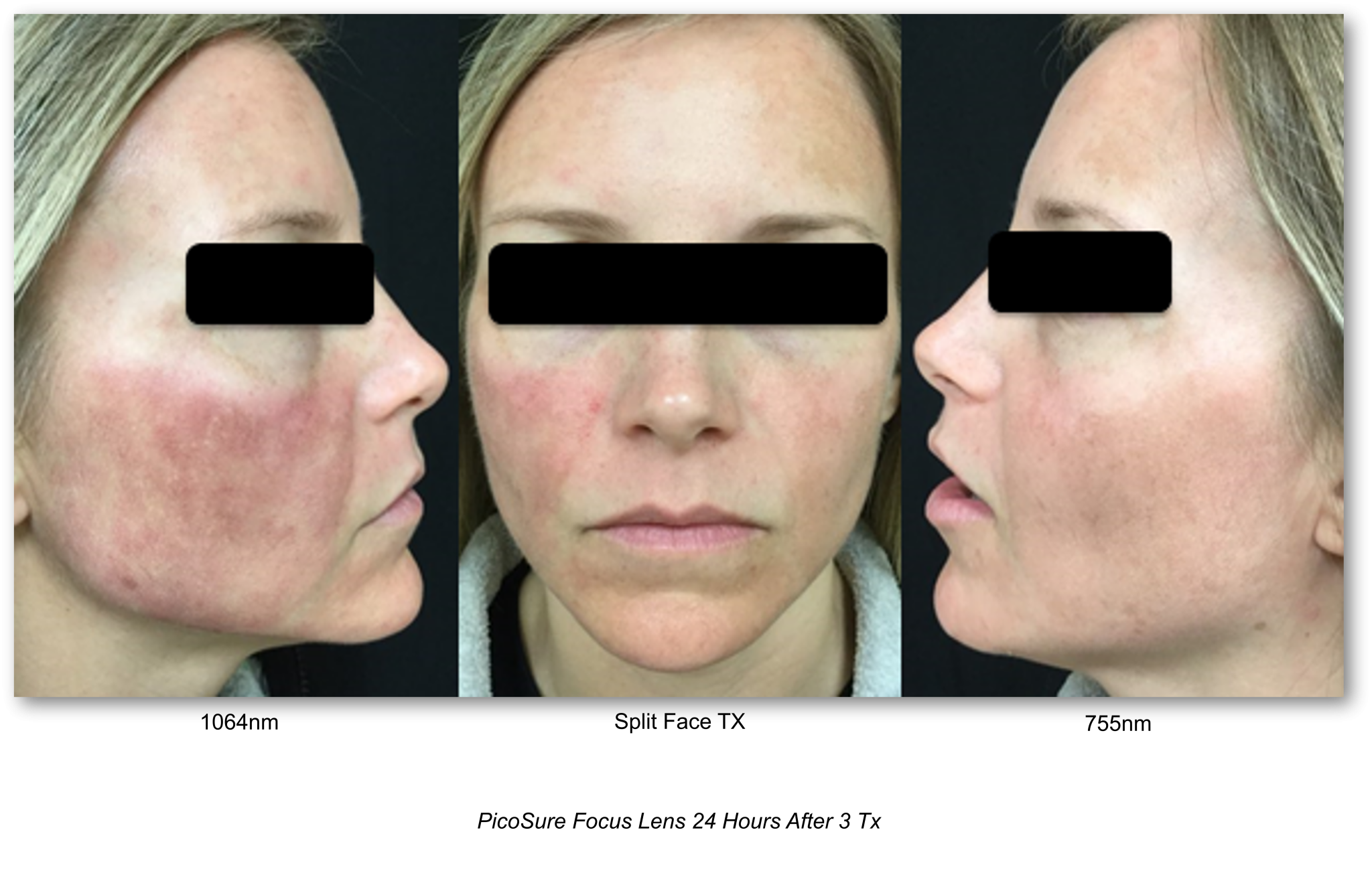 PICOSURE® PRO - The World’s 1st 755nm Picosecond Laser