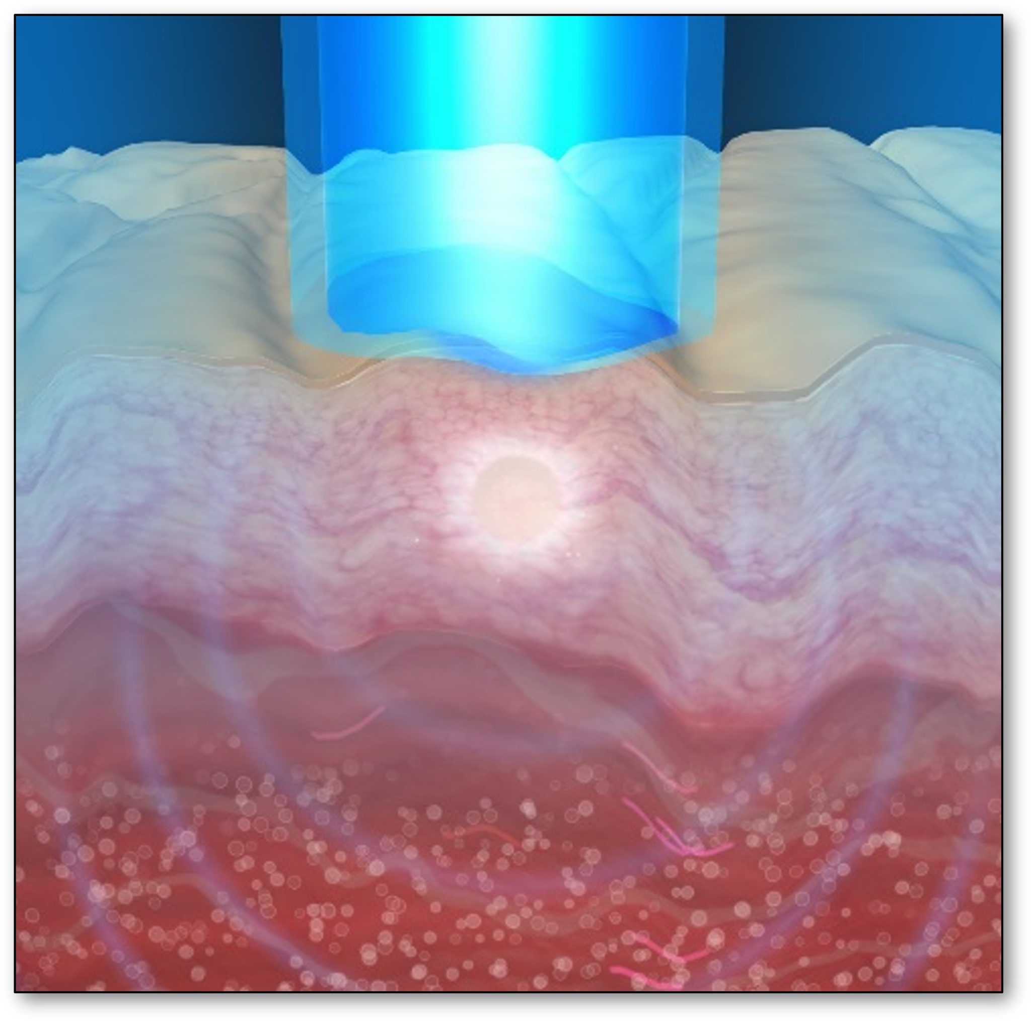 PICOSURE® PRO - The World’s 1st 755nm Picosecond Laser