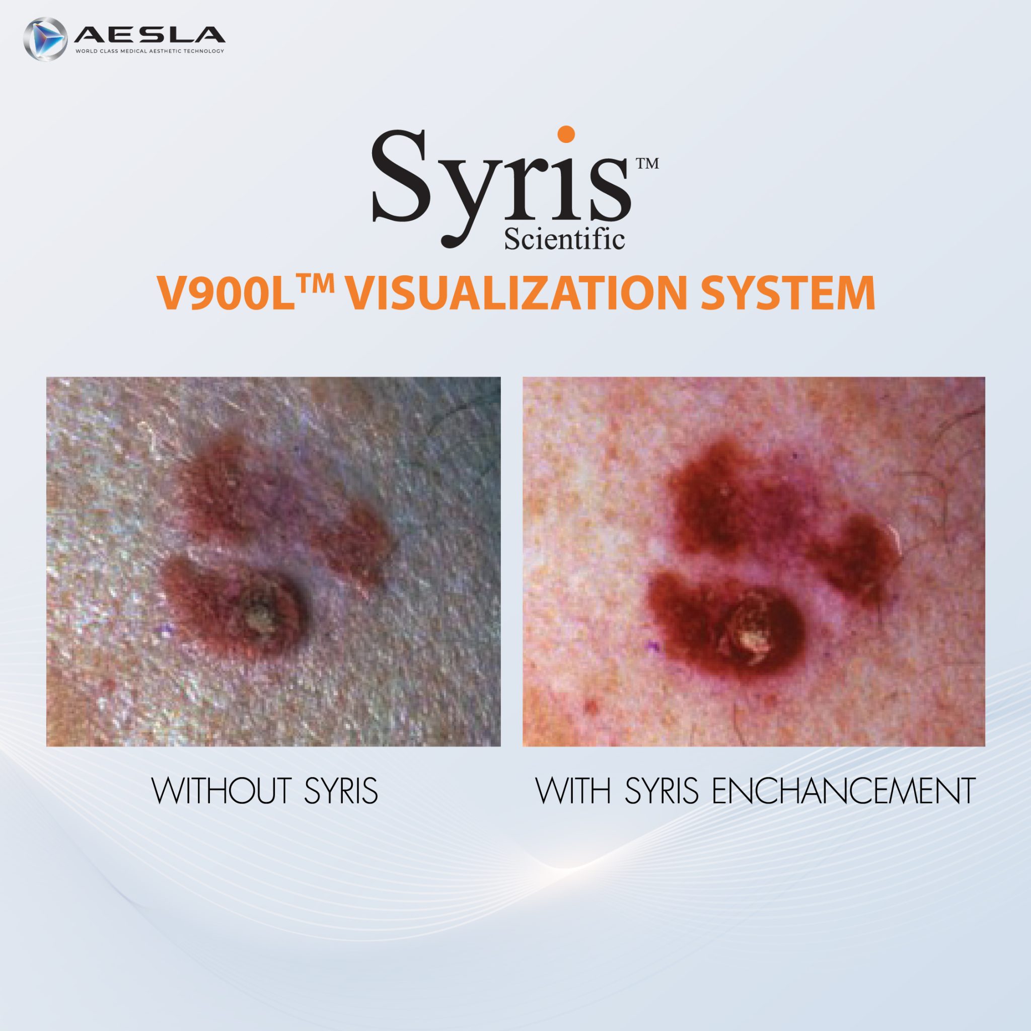 Syris v900L - See Below the Skin’s Surface