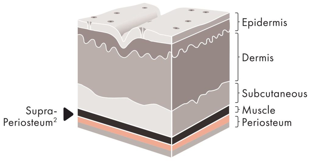 Revanesse® Dermal Filler, Designed for Beauty